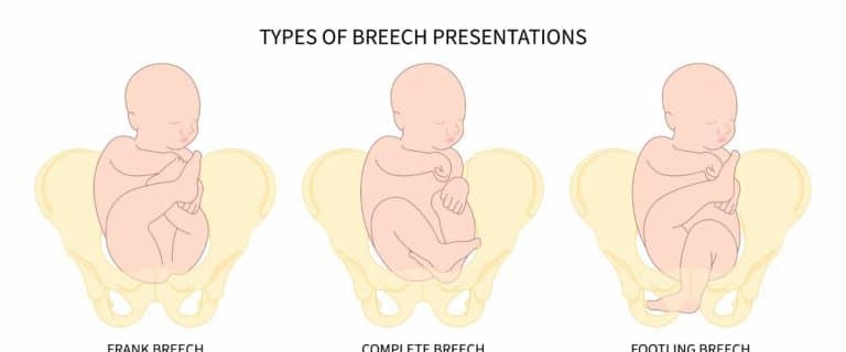 What is the spiritual significance of being born BREECH? - Awakening State