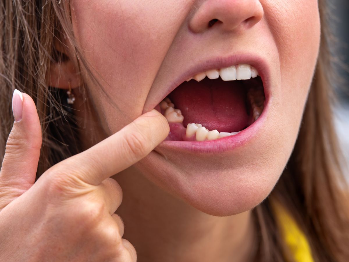 Spiritual Meaning of Teeth Falling Out (dream & real life) - Awakening ...
