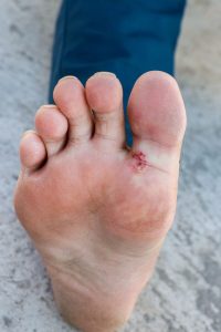 Stubbing Your Toe Spiritual Meaning - Awakening State